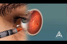 dmla - Messidor Eye Center